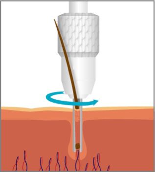 DHİ Hair Transplant - Mercure Istanbul Clinics®